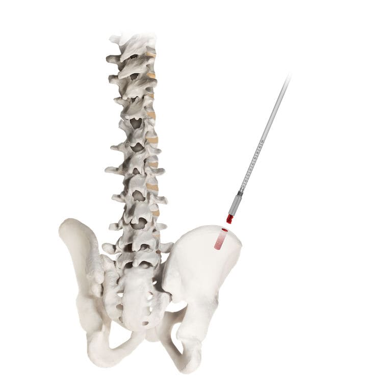 Bone marrow biopsy needle - RETRIEVE® - Globus Medical