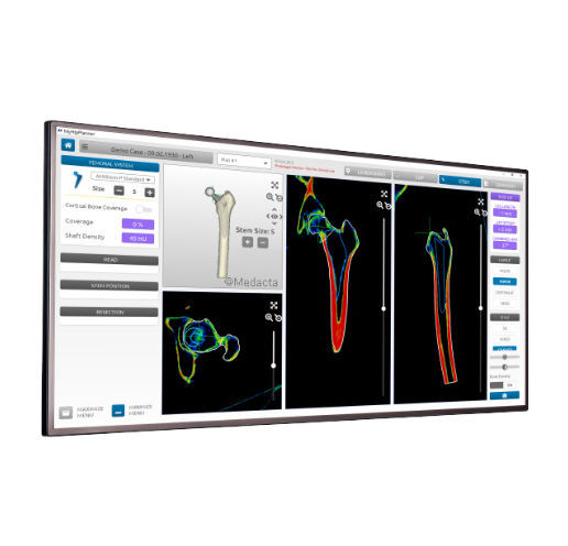 Analysis software - MyHip® - Medacta - planning / CT / hip