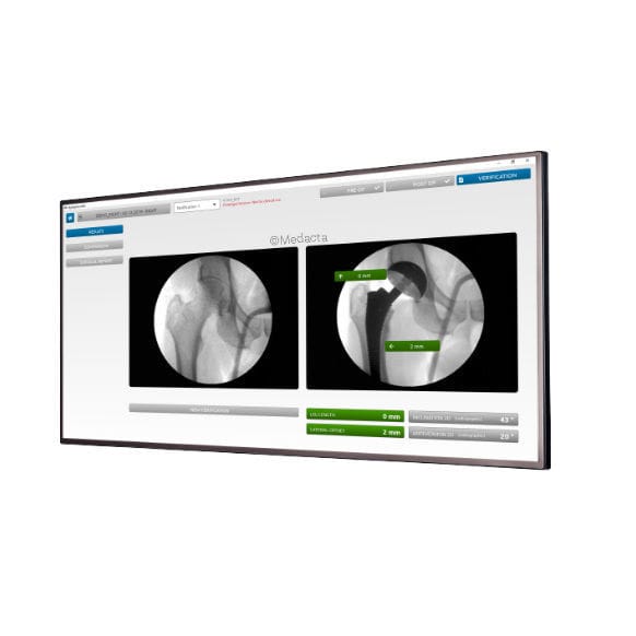 Verification software - MyHip® - Medacta - for hip surgery / hip / for ...