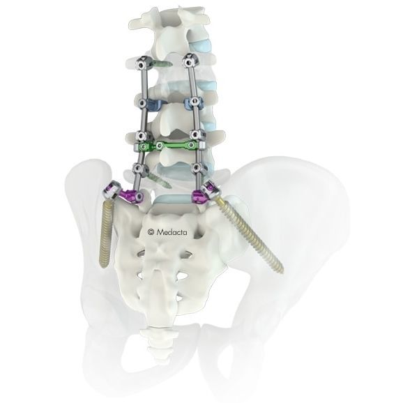 Lumbo-sacral osteosynthesis unit - M.U.S.T.® - Medacta - posterior / adult
