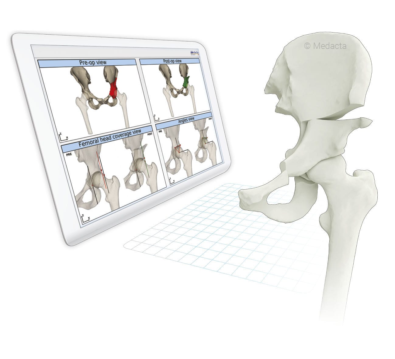 Hip prosthesis resection guide - MyPAO® - Medacta