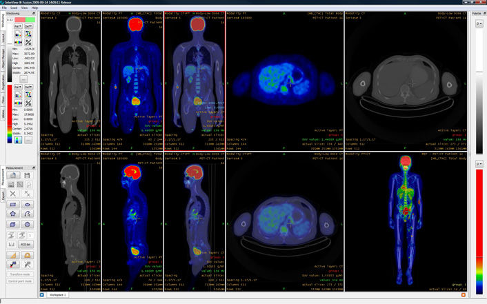 Multimodal image fusion software - InterView™ FUSION - Mediso - medical ...