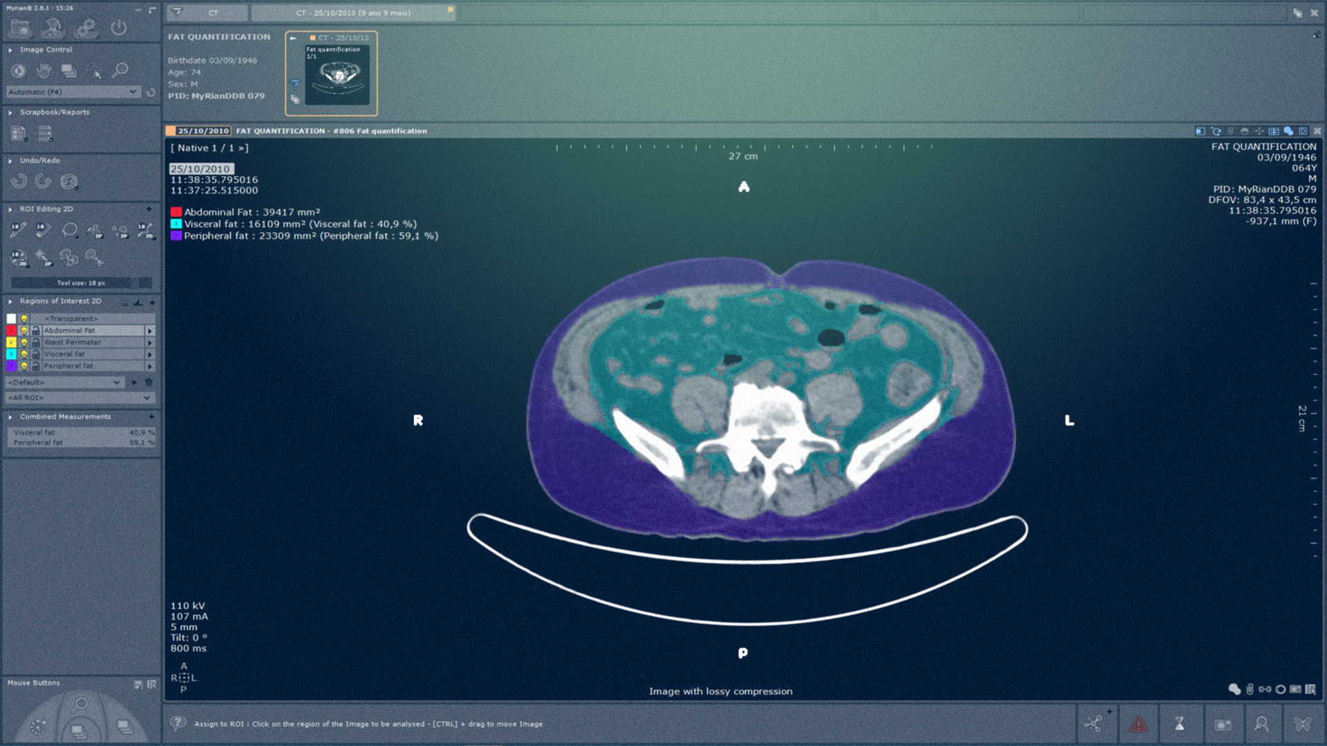 Quantification software module - MYRIAN®XP-ABDOFAT - Intrasense - medical