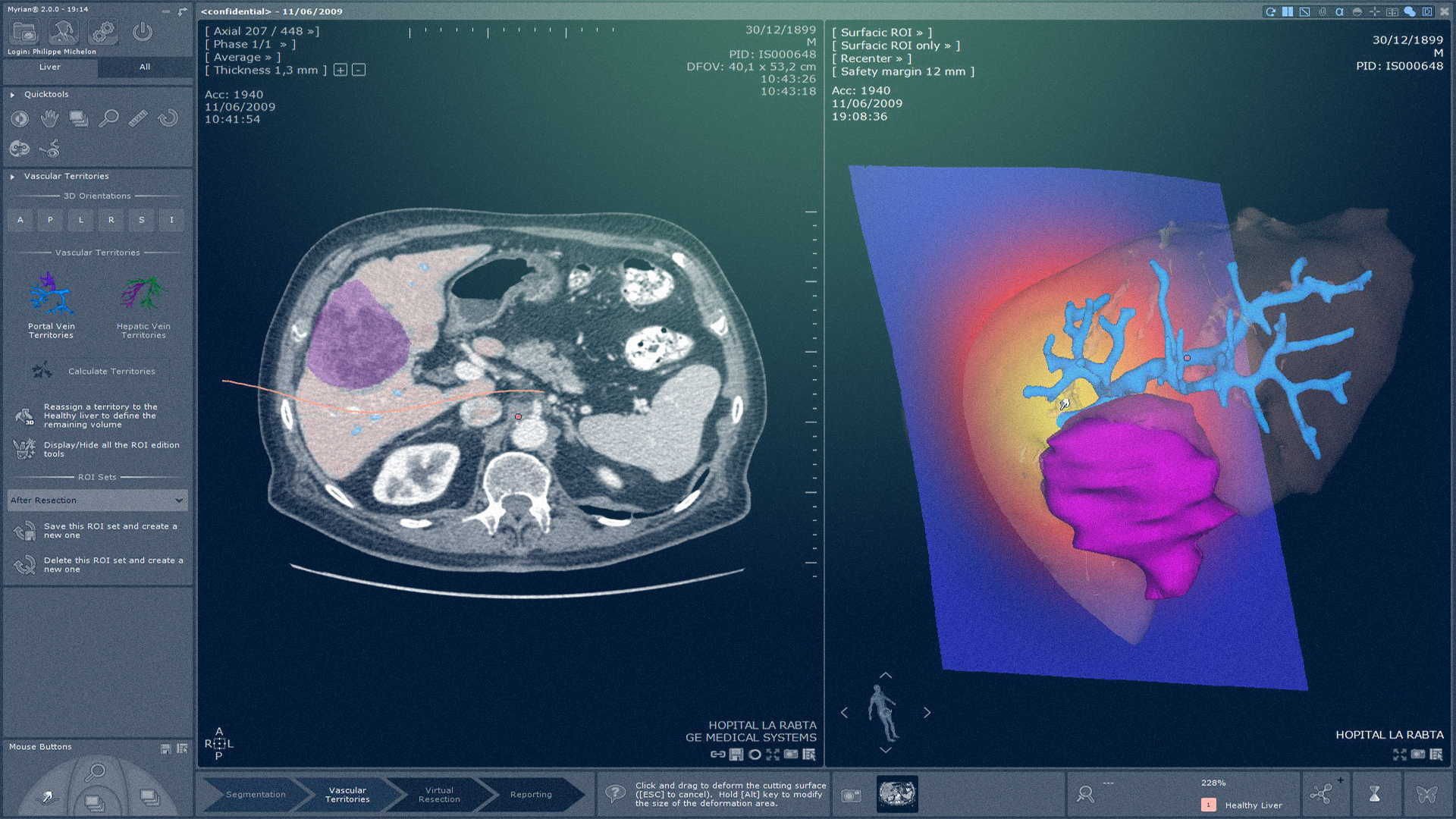Analysis software module - MYRIAN®XP-LIVER MRI - Intrasense ...