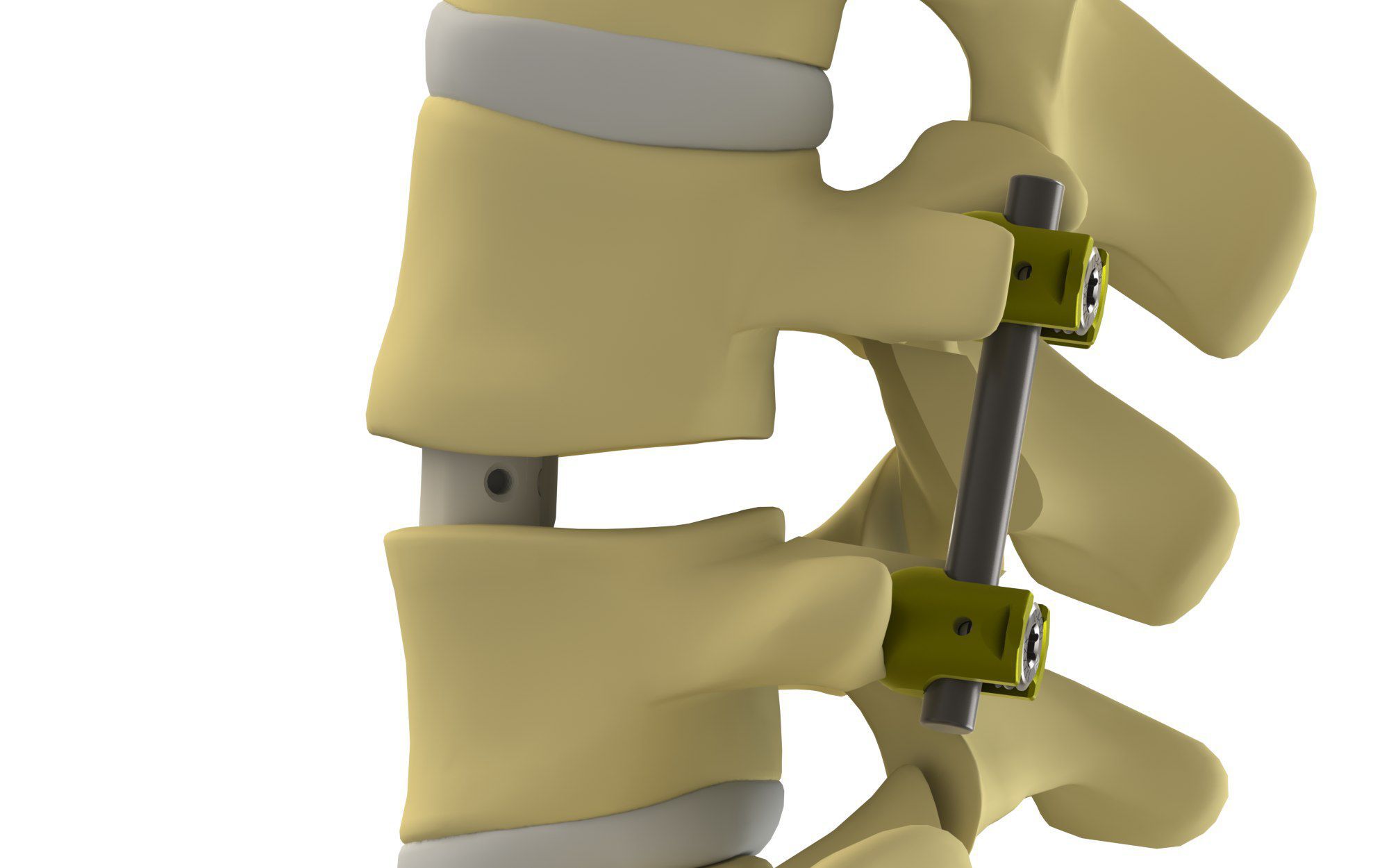 Lumbar interbody fusion cage - HONOUR® TLIF - Nexxt Spine ...