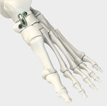 CrossRoads Extremity Systems: Secondary care - MedicalExpo