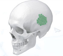 Cranial fixation system - All medical device manufacturers