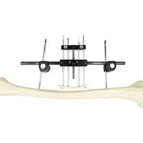 External fixation system - All medical device manufacturers