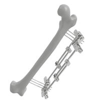 External fixation system - All medical device manufacturers