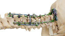 Alphatec Spine: Secondary care - MedicalExpo