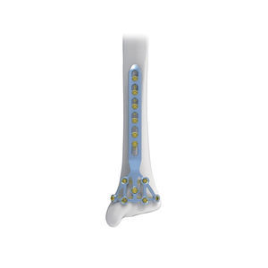 Tibia compression plate - NORMMED Medical Devices - proximal / lateral ...