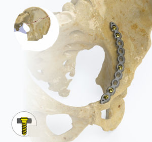 Small bone fragment compression plate - 1232 series - Zimed Medical ...