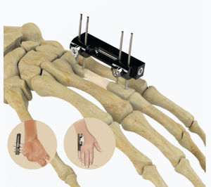 Metatarsophalangeal joint external fixation system - 5884-0000 - Zimed ...