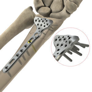 Radius compression plate - L Shape DR Posterior - Ases Orthopedics ...