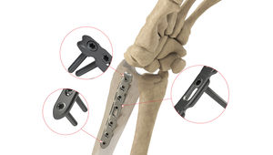 Radius compression plate - DR Volar - Ases Orthopedics - distal / locking