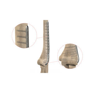 Radius compression plate - Ases Orthopedics - locking