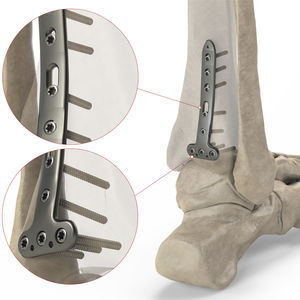 Tibia compression plate - Ases Orthopedics - distal / anterolateral ...