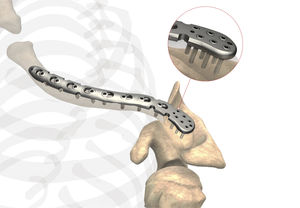 Clavicle compression plate - Ases Orthopedics - locking