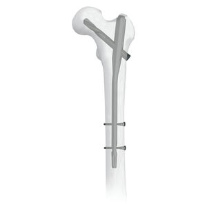 Tibial intramedullary nail - 305050 series - Boneunion Medical ...