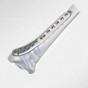 Tibia compression plate - LOQTEQ® 3.5 - aap Implantate - distal ...