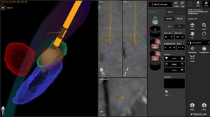 Treatment planning software - Elements - Brainlab - medical / oncology ...