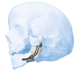 Cranial implant - MatrixNEURO™ - Depuy Synthes