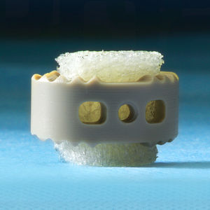 Allograft bone substitute - AlphaGRAFT® DBM - Alphatec Spine - for ...