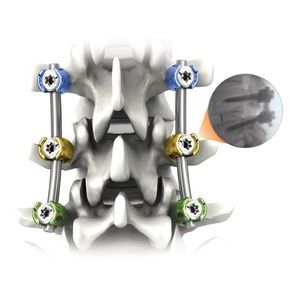 Thoraco-lumbar osteosynthesis unit - ARx® - Life Spine - posterior / adult