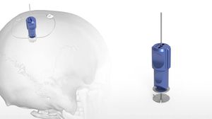 Non-absorbable cranial fixation system - Fast Flap™ - Acumed