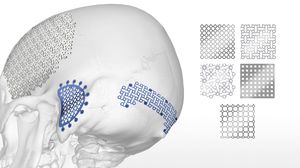 Custom-made cranial implant - Matrix Omnipore® - Acumed