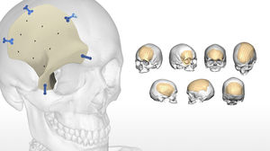 Custom-made cranial implant - Matrix Omnipore® - Acumed