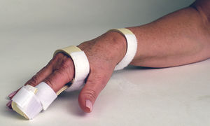 Baseball finger splint - 0814 63 series - Bird & Cronin