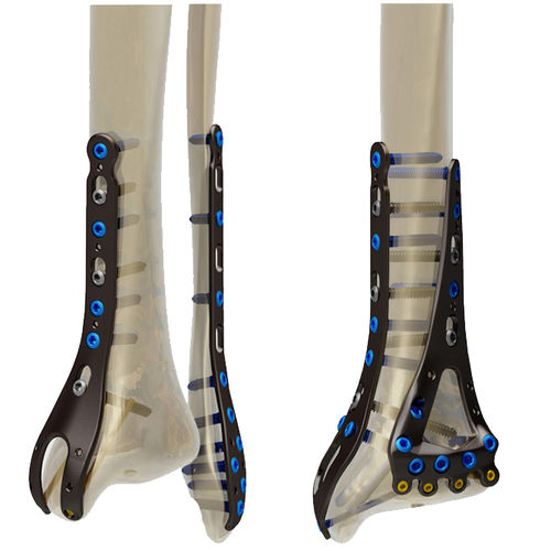 Fibula compression plate - STEP® - Response Ortho - tibia / distal ...