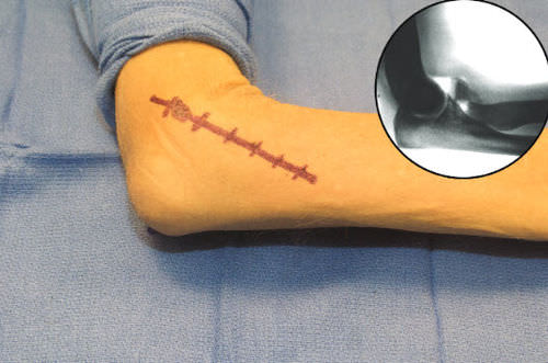 Radial head prosthesis - ALIGN ® - Skeletal Dynamics