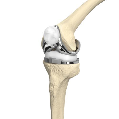 Total knee prosthesis - Canwell Medical