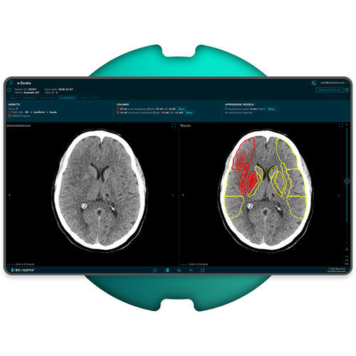 Stroke diagnosis software - e-Stroke - Brainomix - image analysis / visualization / acquisition
