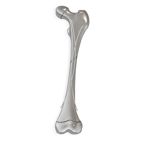 Femoral intramedullary nail - pediFlex™ - OrthoPediatrics - tibia ...