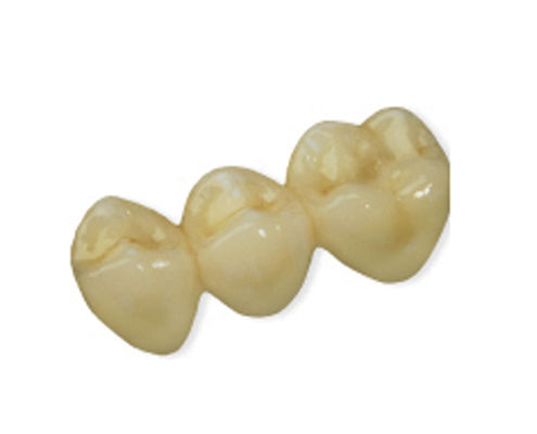 PMMA dental bridge - CAD Temp - Derby Dental - anterior teeth ...