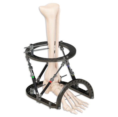 Ankle external fixation system - Quartz - Selaz - circular / adult