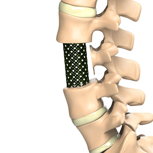 Lumbar vertebral corpectomy prosthesis - Ti-6Al-4V ELI - Aditus Medical ...