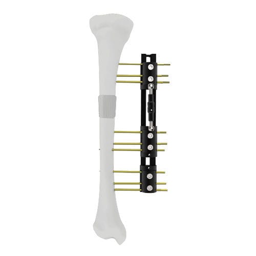 Tibia external fixation system - LRS - Peditst - femur / tubular ...
