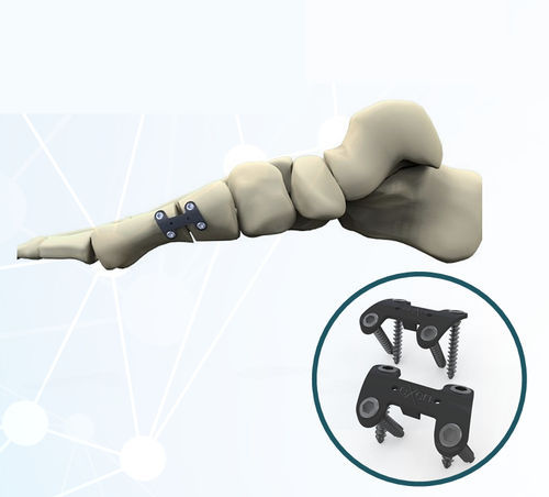 Hallux valgus arthrodesis plate - FRC20 series - Aleda Medical ...