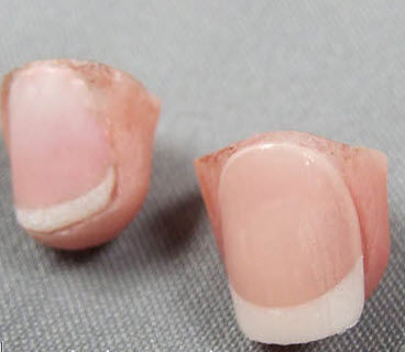 Finger cosmetic prosthesis - Medical Art Prosthetics - partial / adult