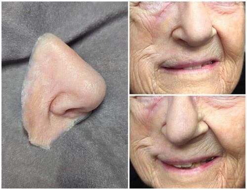 Nasal cosmetic prosthesis - lifelike - Medical Art Prosthetics - adult