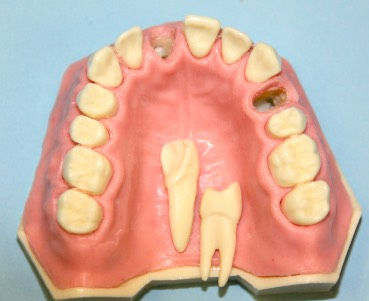 Maxilla anatomical model - APIC-1 - Selmodels SL - teeth / dental ...