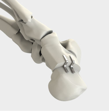 Calcaneal displacement osteotomy bone staple - DynaFORCE® Step ...