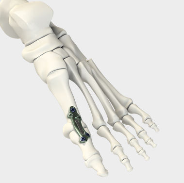 Metatarsophalangeal joint arthrodesis plate - DynaFORCE® MPJ ...