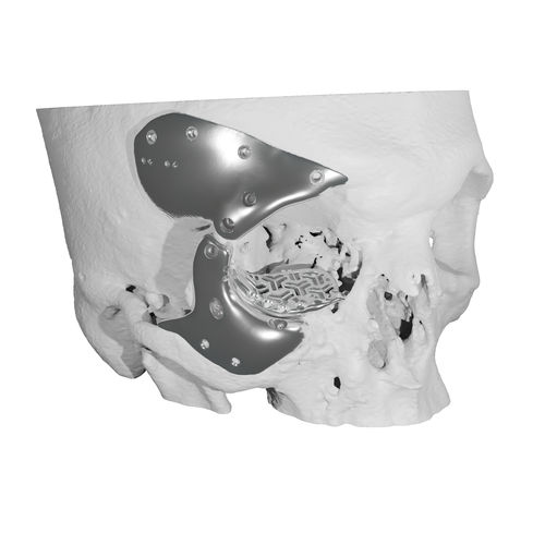 Maxillofacial compression plate - Custom-made implant - Ortho Baltic ...