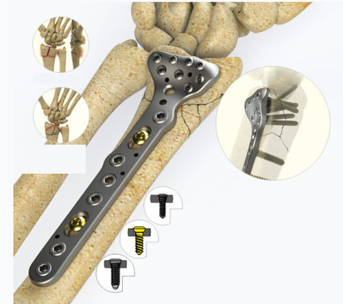 Radius compression plate - 1442 series - Zimed Medical - distal ...
