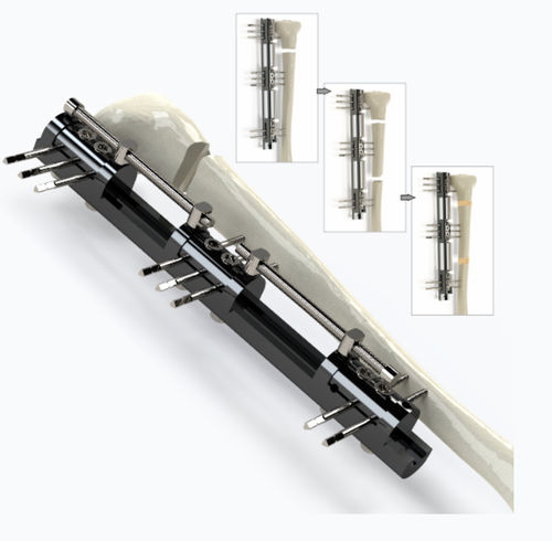 Tibia external fixation system - 5074 series - Zimed Medical - tubular ...